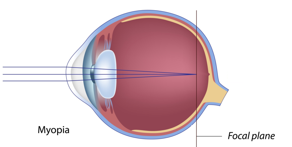 What is LASIK? - Wills Laser Vision