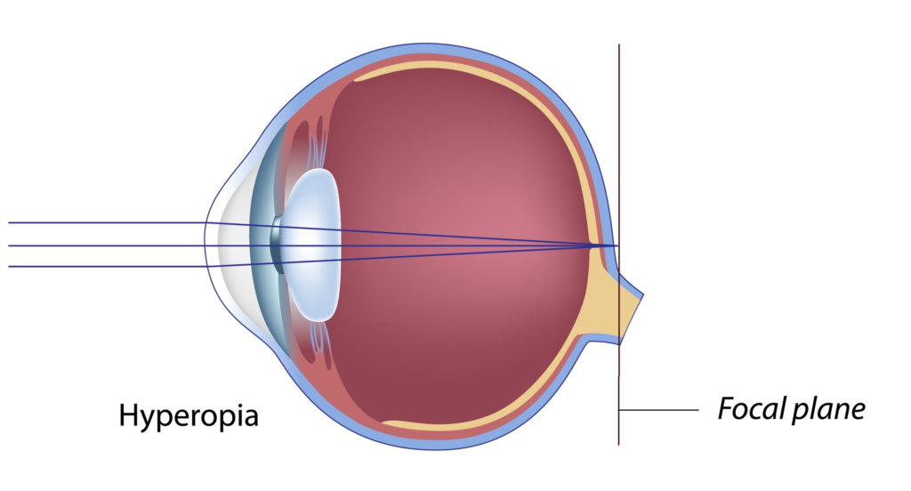 What is LASIK? - Wills Laser Vision